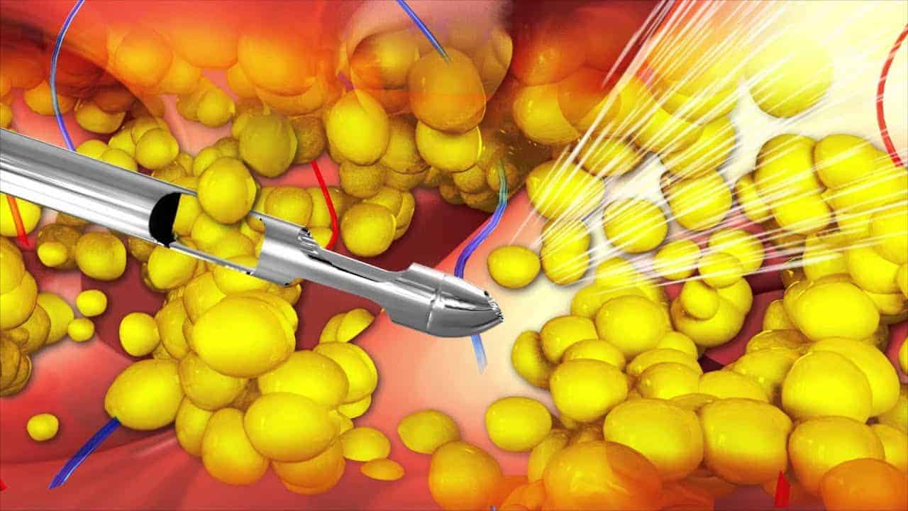 Body Jet Water-Assisted Lipoplasty: Your Essential Guide