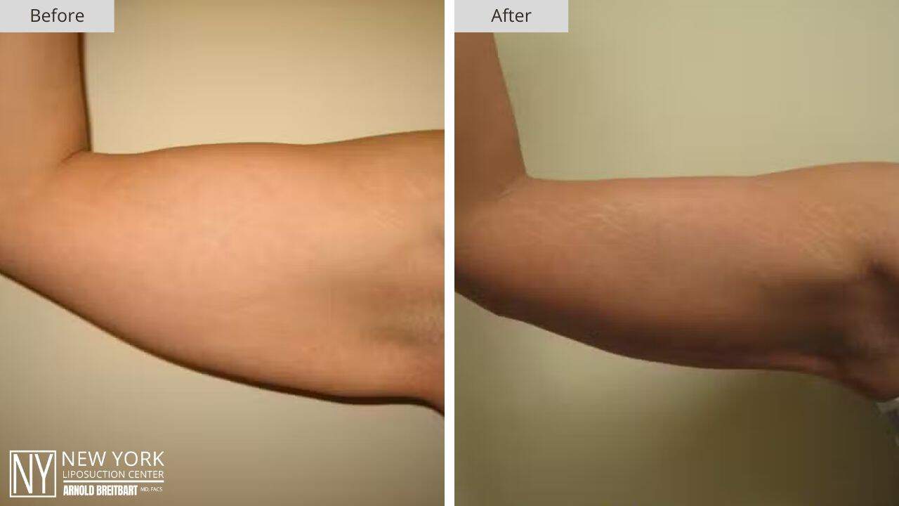 Arm Lift & Liposuction in NYC | New York Liposuction Center