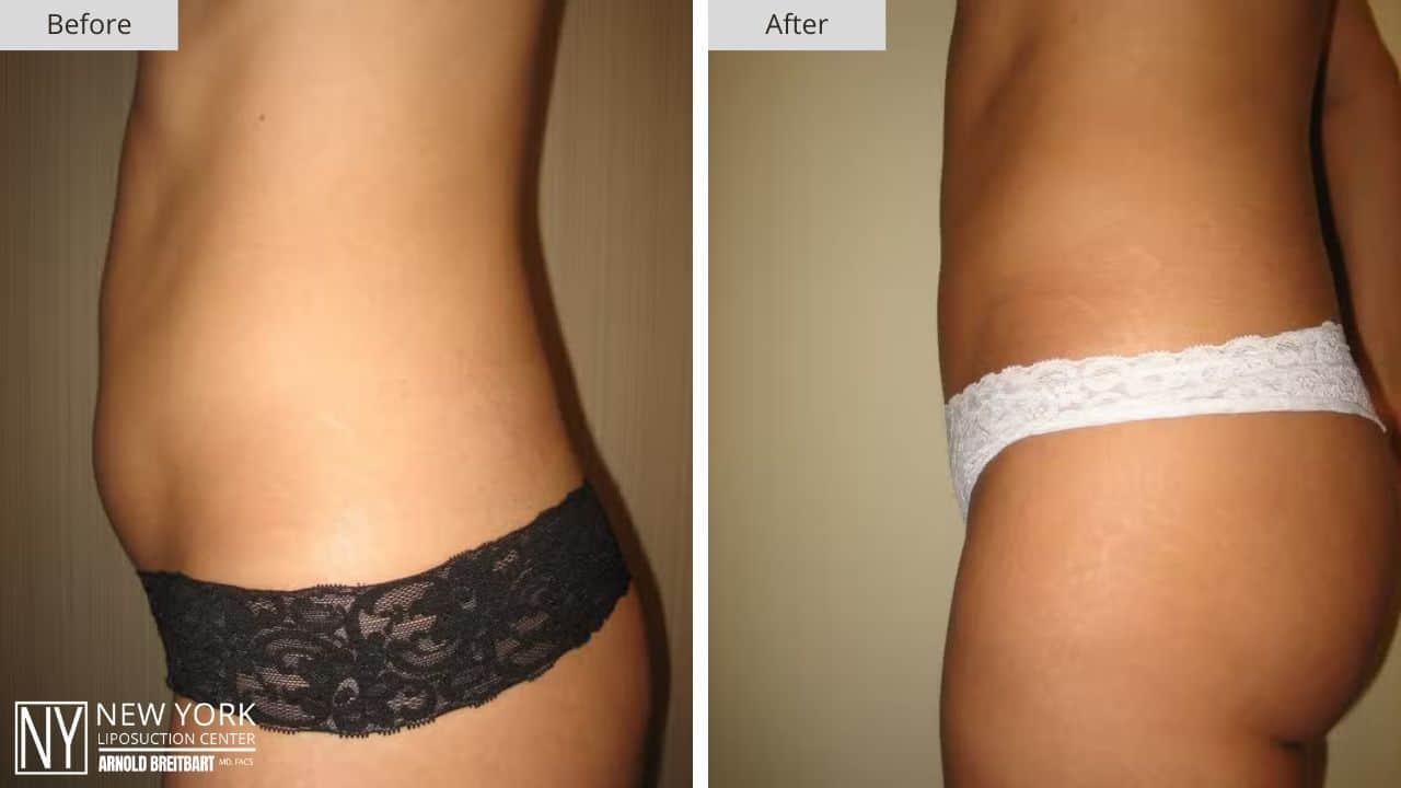 FUPA Liposuction in NYC | New York Liposuction Center