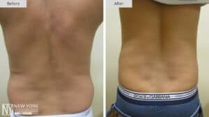 Lipo 360 Surgery in NYC | New York Liposuction Center