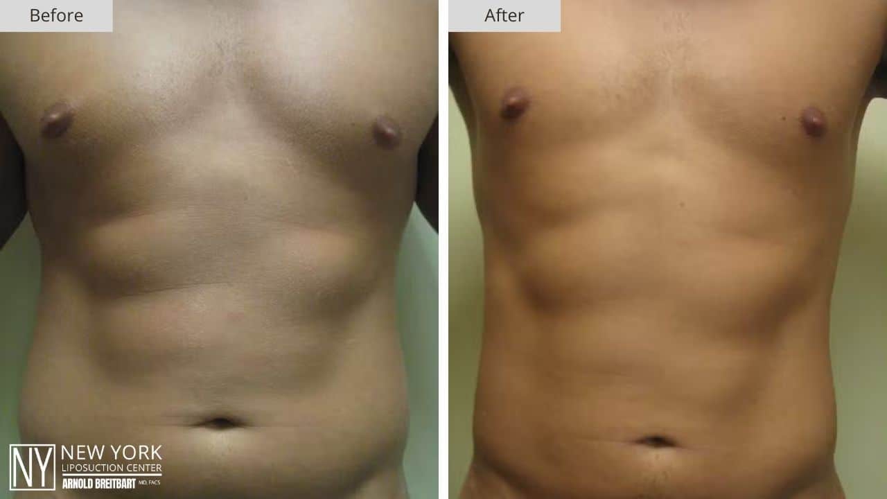 Male Liposuction Surgery in NYC | New York Liposuction Center