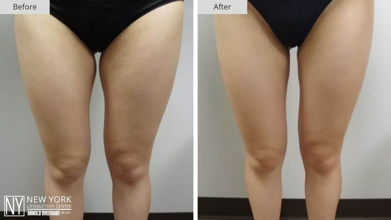 Thigh Liposuction in NYC (Inner & Outer Thigh Lipo) | New York Liposuction Center