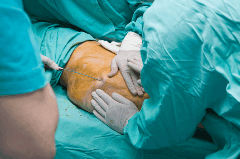 What Are the Different Types of Liposuction? A Complete Guide